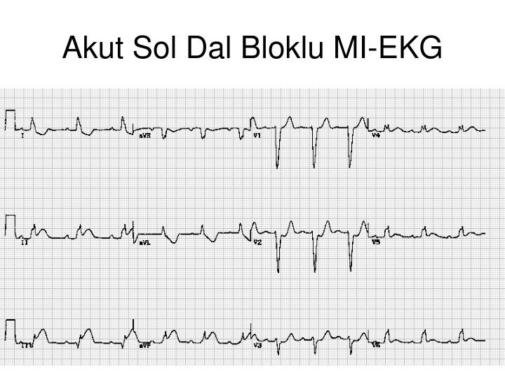 PPT - Elektrokardiyografi PowerPoint Presentation - ID:4633173