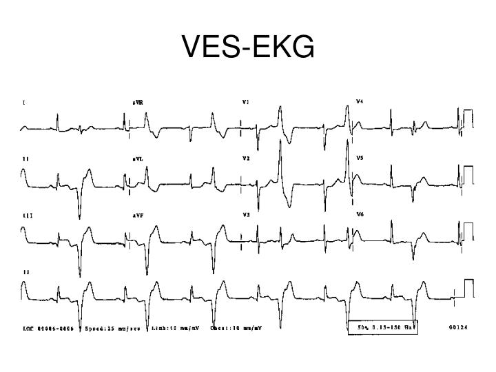 PPT - Elektrokardiyografi PowerPoint Presentation - ID:4633173
