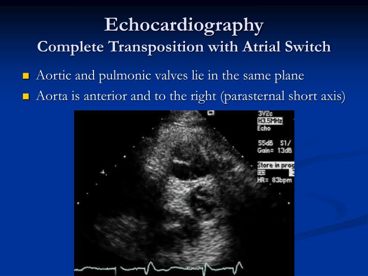 PPT - Transposition of the Great Arteries PowerPoint Presentation - ID ...