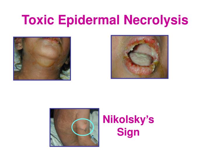 PPT - Emergencies in Pediatric Dermatology PowerPoint Presentation - ID ...