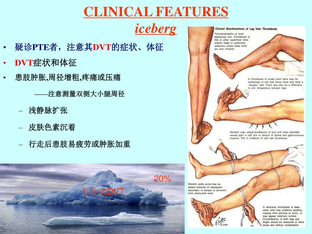 PPT - VENOUS THROMBOEMBOLISM( VTE ) DEEP VENOUS THROMBOSIS ( DVT ...