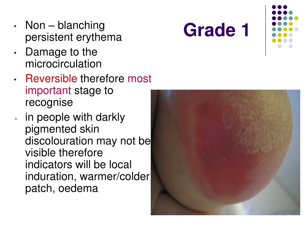 PPT - PREVENTION OF HOSPITAL ACQUIRED PRESSURE ULCERS Mandatory session ...