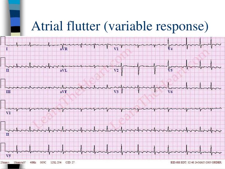 PPT - Atrial fibrillation and flutter: Practical Management Tips ...