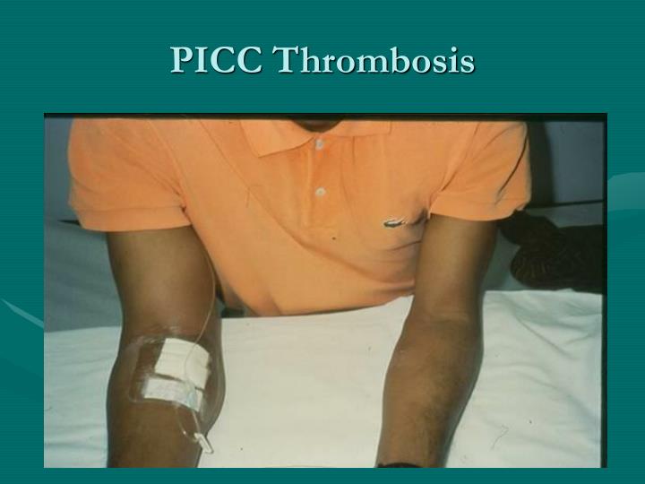 PPT - Venous Access Devices in Clinical Practice PowerPoint ...