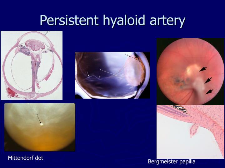 PPT - Pediatric Optometry PowerPoint Presentation - ID:4648684