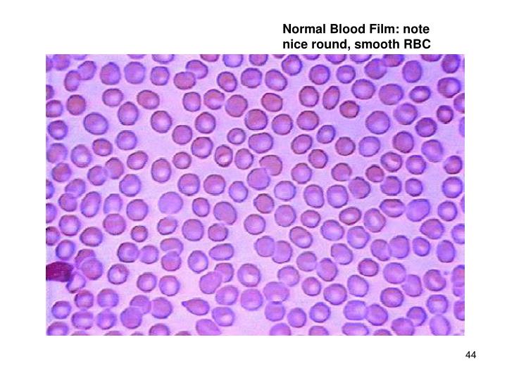 PPT - Approach to Low Blood Counts: Thrombocytopenia PowerPoint ...