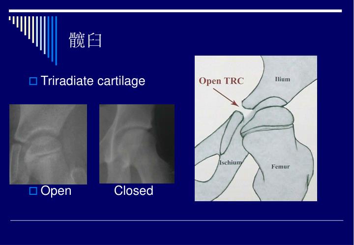PPT - 特发性脊柱侧弯 Adolescence Idiopathic Scoliosis -- 从基本理论到临床 PowerPoint ...