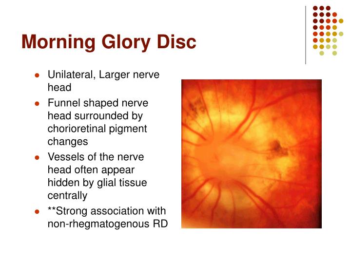 PPT - Optic Nerve Disease PowerPoint Presentation - ID:4655272