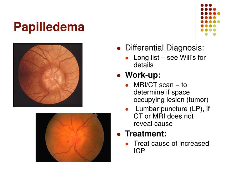 PPT - Optic Nerve Disease PowerPoint Presentation - ID:4655272