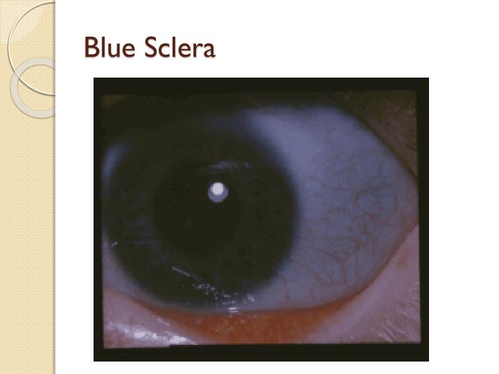 PPT - Osteogenesis Imperfecta PowerPoint Presentation - ID:4667073