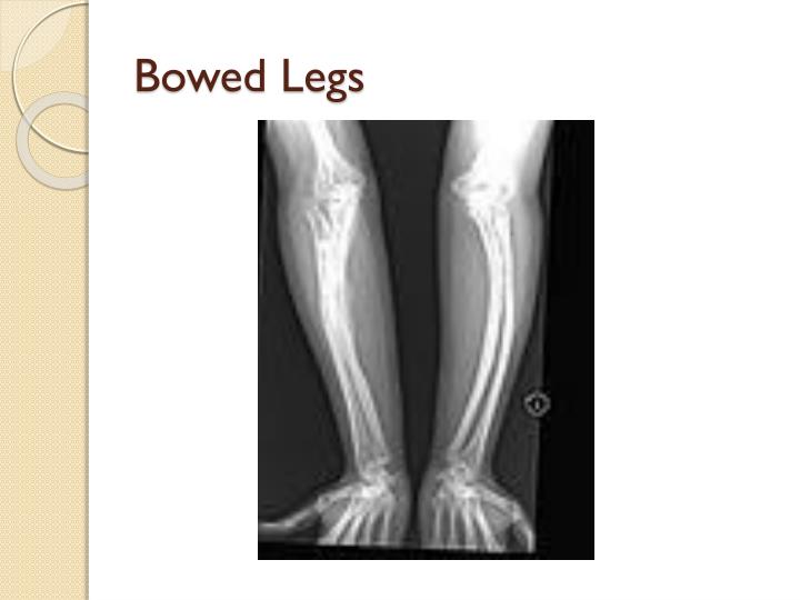 PPT - Osteogenesis Imperfecta PowerPoint Presentation - ID:4667073