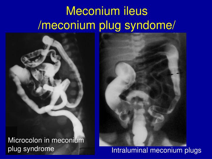 PPT - DIAGNOSTIC IMAGING OF GASTROINTESTINAL TRACT IN CHILDREN ...