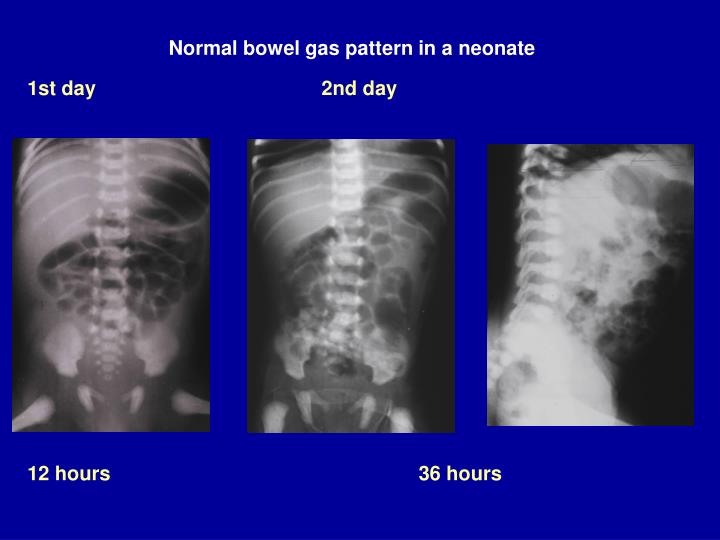 PPT - DIAGNOSTIC IMAGING OF GASTROINTESTINAL TRACT IN CHILDREN ...