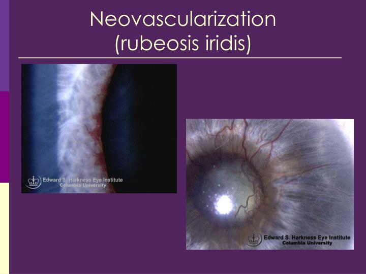 PPT - Diabetes and the Eye PowerPoint Presentation - ID:4671726