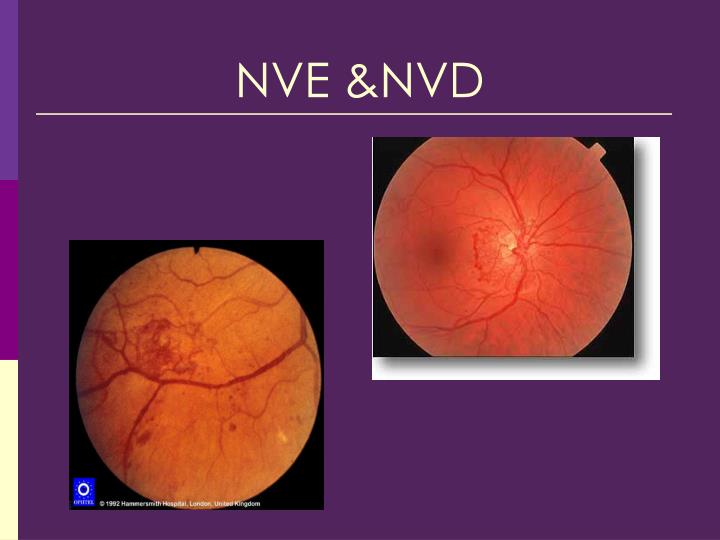 PPT - Diabetes and the Eye PowerPoint Presentation - ID:4671726