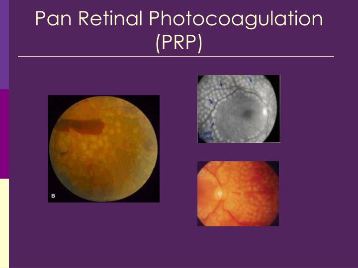 PPT - Diabetes and the Eye PowerPoint Presentation - ID:4671726