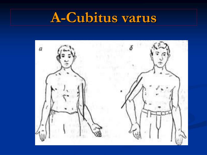 PPT - Deformities PowerPoint Presentation - ID:4675237