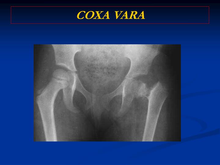 PPT - Deformities PowerPoint Presentation - ID:4675237