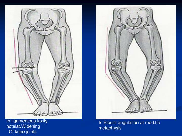 PPT - Deformities PowerPoint Presentation - ID:4675237