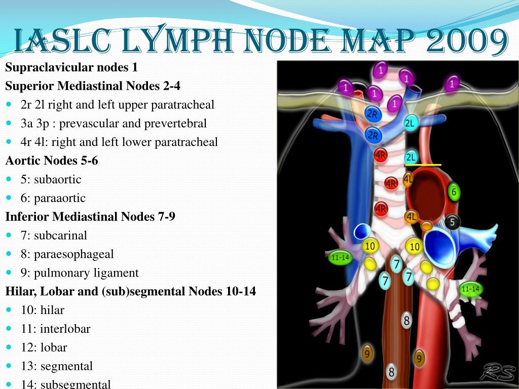 Lymph Node Cancer Stages Hot Sex Picture
