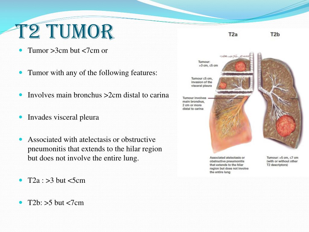 Ppt Lung Cancer Staging Powerpoint Presentation Free Download Id4678509