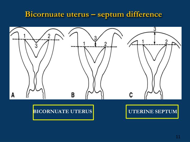 Bicornuate