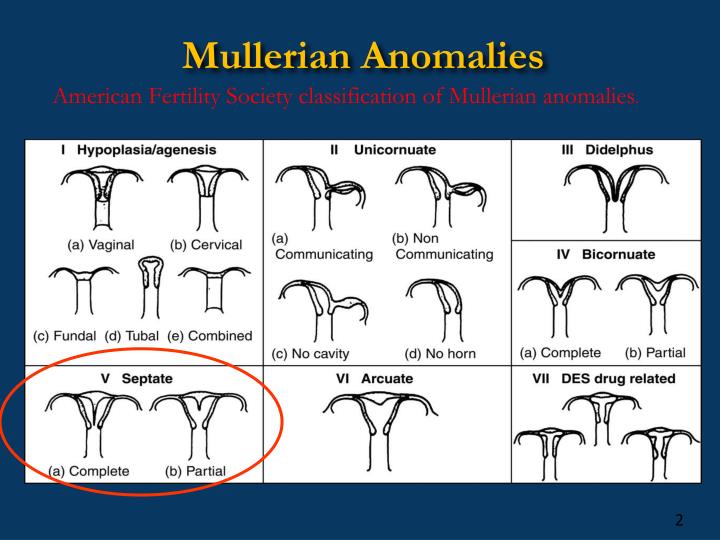 PPT - HYSTEROSCOPIC SEPTUM RESECTION PowerPoint Presentation - ID:4681029