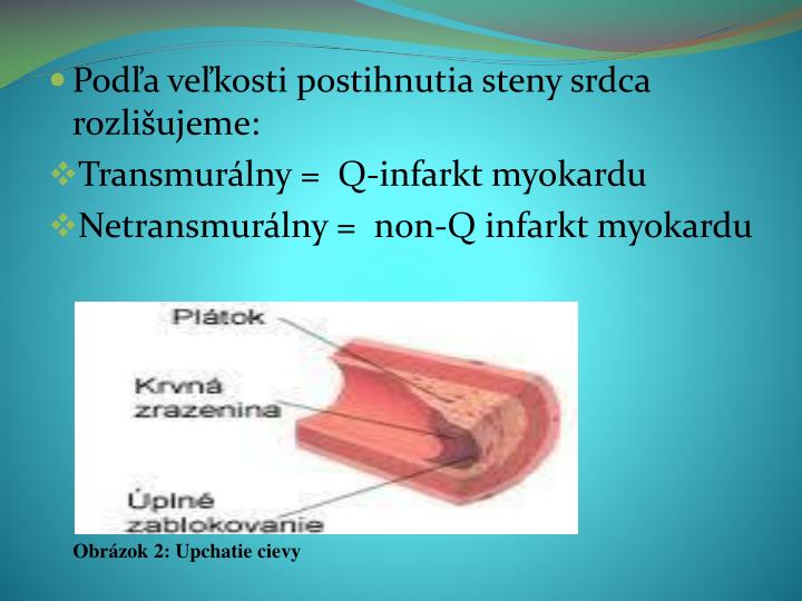 PPT - Infarkt myokardu PowerPoint Presentation - ID:4689788