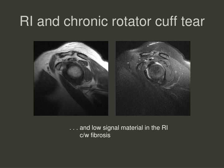 PPT - Anatomy and Pathology of the Rotator Interval PowerPoint ...