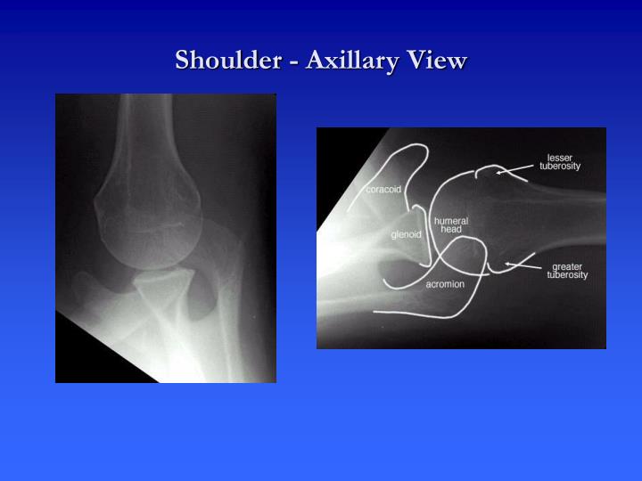 PPT - ANATOMIE RADIOLOGIQUE DE L’EPAULE PowerPoint Presentation - ID ...