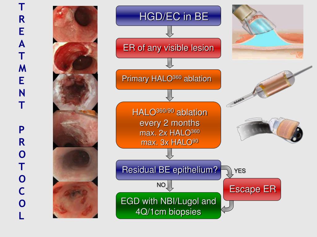 PPT - Novel developments Radiofrequency Ablation (RFA) for dysplastic ...