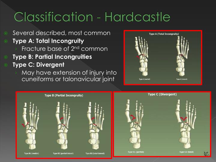 PPT - LISFRANC INJURIES PowerPoint Presentation - ID:4701679