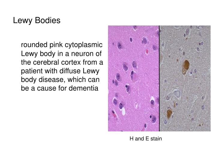 Lewy Bodies