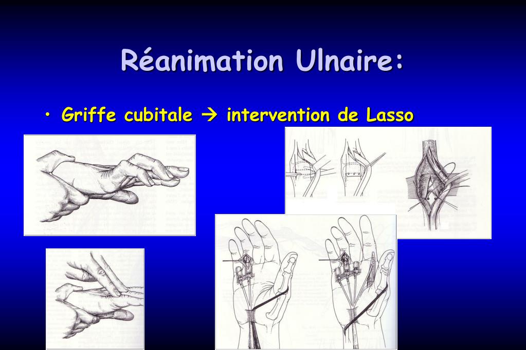 PPT - Place de la chirurgie palliative pour la main paralytique ...