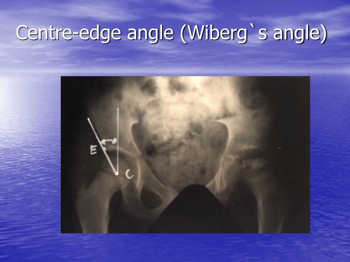 PPT - Legg-Calve-Perthes Disease S. Maryam Moghadam PowerPoint ...