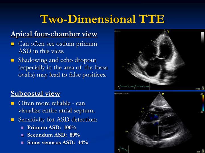 PPT - Atrial Septal Defects PowerPoint Presentation - ID:4712917