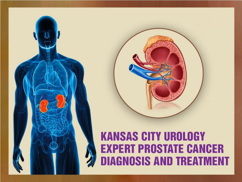Ppt Cutting Edge Technology Helping Prostate Cancer Treatment
