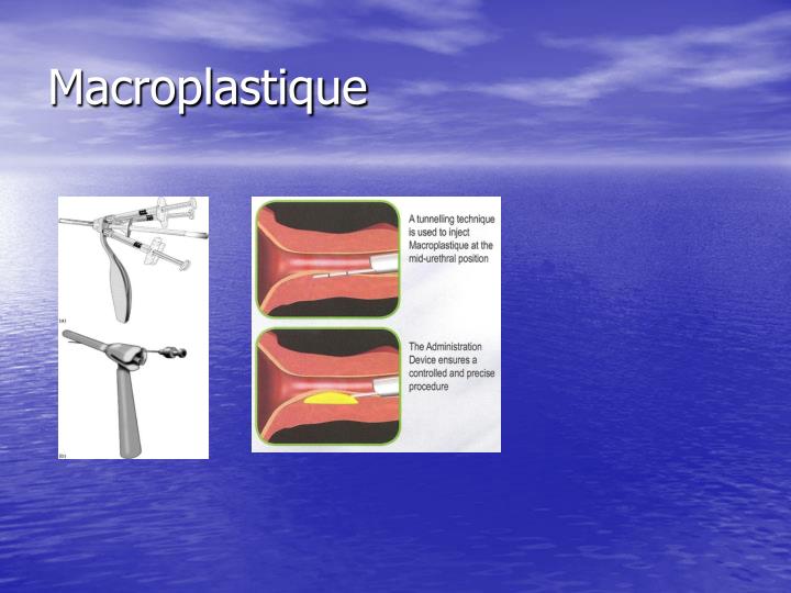 PPT - L’INCONTINENZA URINARIA FEMMINILE PowerPoint Presentation - ID ...