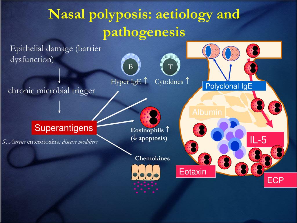 Ppt Nasal Polyps Pathogenesis And Treatment Implications Powerpoint