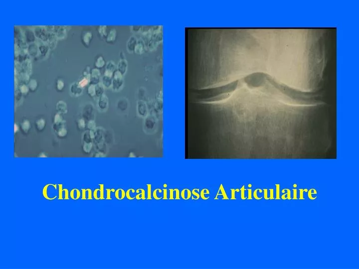 PPT - Chondrocalcinose Articulaire PowerPoint Presentation, free ...