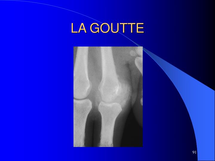PPT - LES RHUMATISMES INFLAMMATOIRES PowerPoint Presentation - ID:4734688