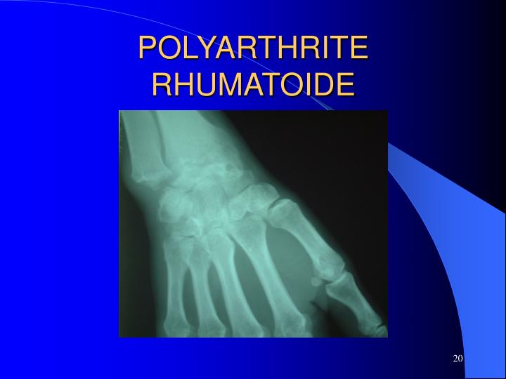 PPT - LES RHUMATISMES INFLAMMATOIRES PowerPoint Presentation - ID:4734688