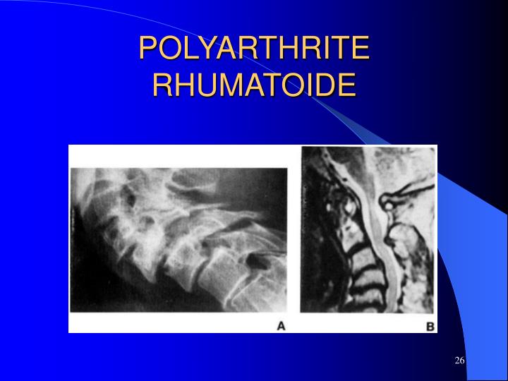 PPT - LES RHUMATISMES INFLAMMATOIRES PowerPoint Presentation - ID:4734688