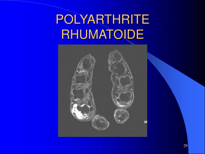 PPT - LES RHUMATISMES INFLAMMATOIRES PowerPoint Presentation - ID:4734688