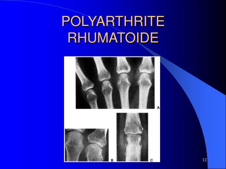 PPT - LES RHUMATISMES INFLAMMATOIRES PowerPoint Presentation - ID:4734688