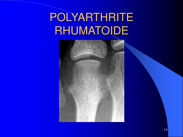 PPT - LES RHUMATISMES INFLAMMATOIRES PowerPoint Presentation - ID:4734688
