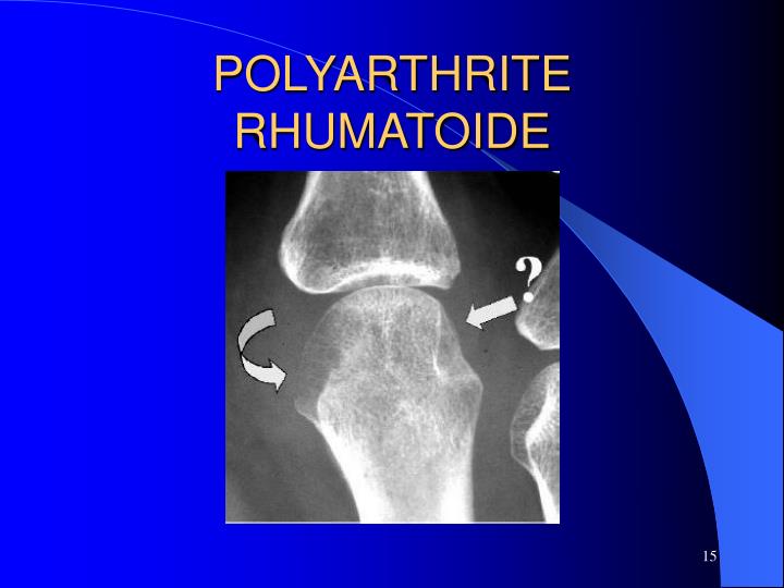PPT - LES RHUMATISMES INFLAMMATOIRES PowerPoint Presentation - ID:4734688