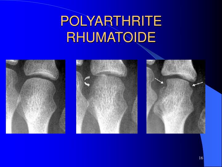 PPT - LES RHUMATISMES INFLAMMATOIRES PowerPoint Presentation - ID:4734688