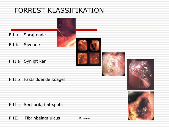 PPT - Øvre Gastrointestinal blødning PowerPoint Presentation - ID:4740066