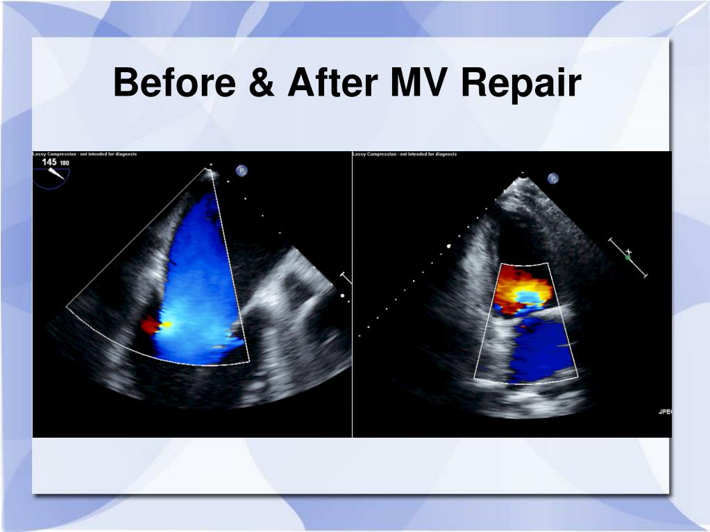 PPT - Mitral Valve Repair Case Study Deborah Jeanne Warner November 10 ...